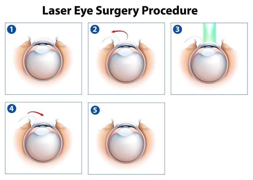 Lasik Vs Lasek Vs Prk Laser Eye Surgery Hub