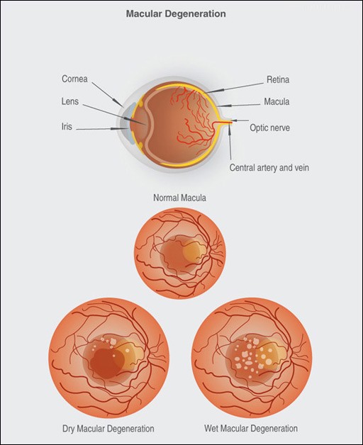 A Comprehensive Guide To Age Related Macular Degeneration AMD Laser